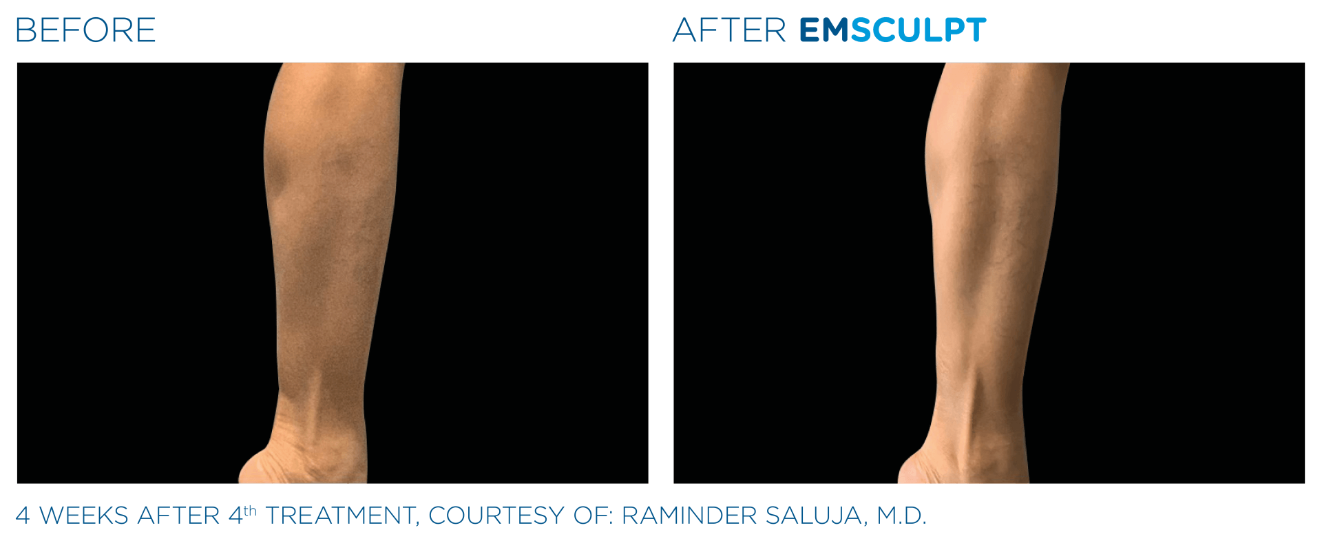 Chisel Your Calves and Arms with EMSCULPT Body Sculpting | Columbus, OH ...