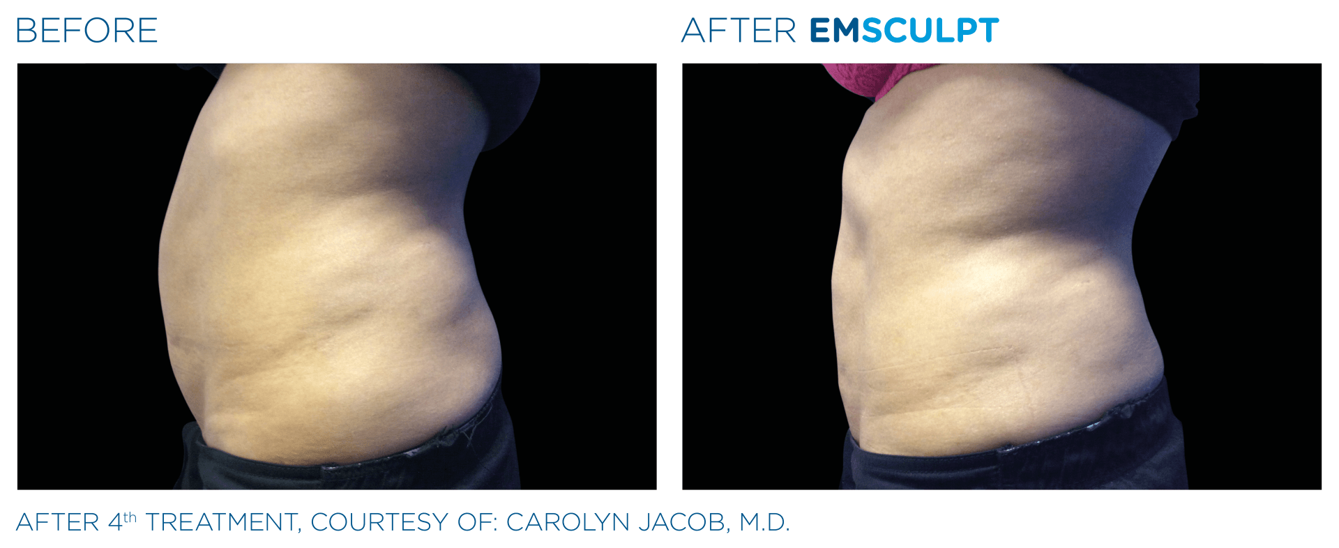 Body Sculpting by EMSCULPT | Columbus, OH | Columbus EMSCULPT