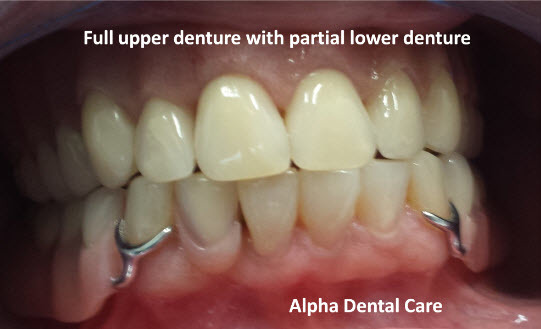 Removable Dentures with Implants St Louis|Overdentures|Alpha Dental Care
