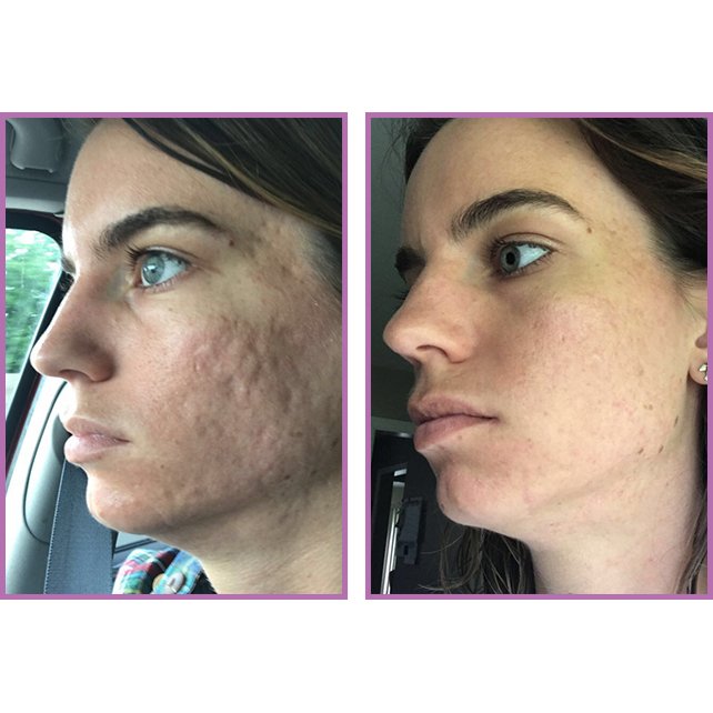 Absolute Skin & Body Care - Thermal Lifting