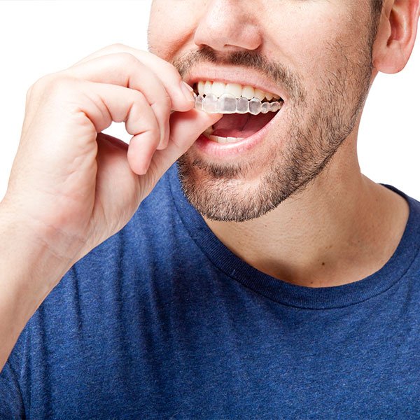 Invisalign® Invisible Braces