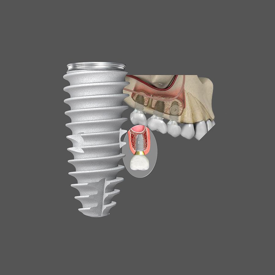 Neobiotech dantų implantai