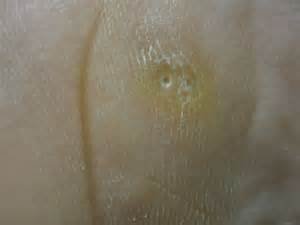 Solutions for foot infections from The Diss Chiropoday and Podiatry Clinic