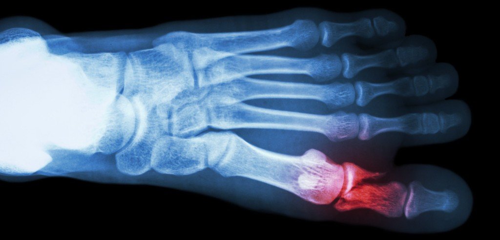 Cheilectomy Surgery to Treat Foot Arthritis