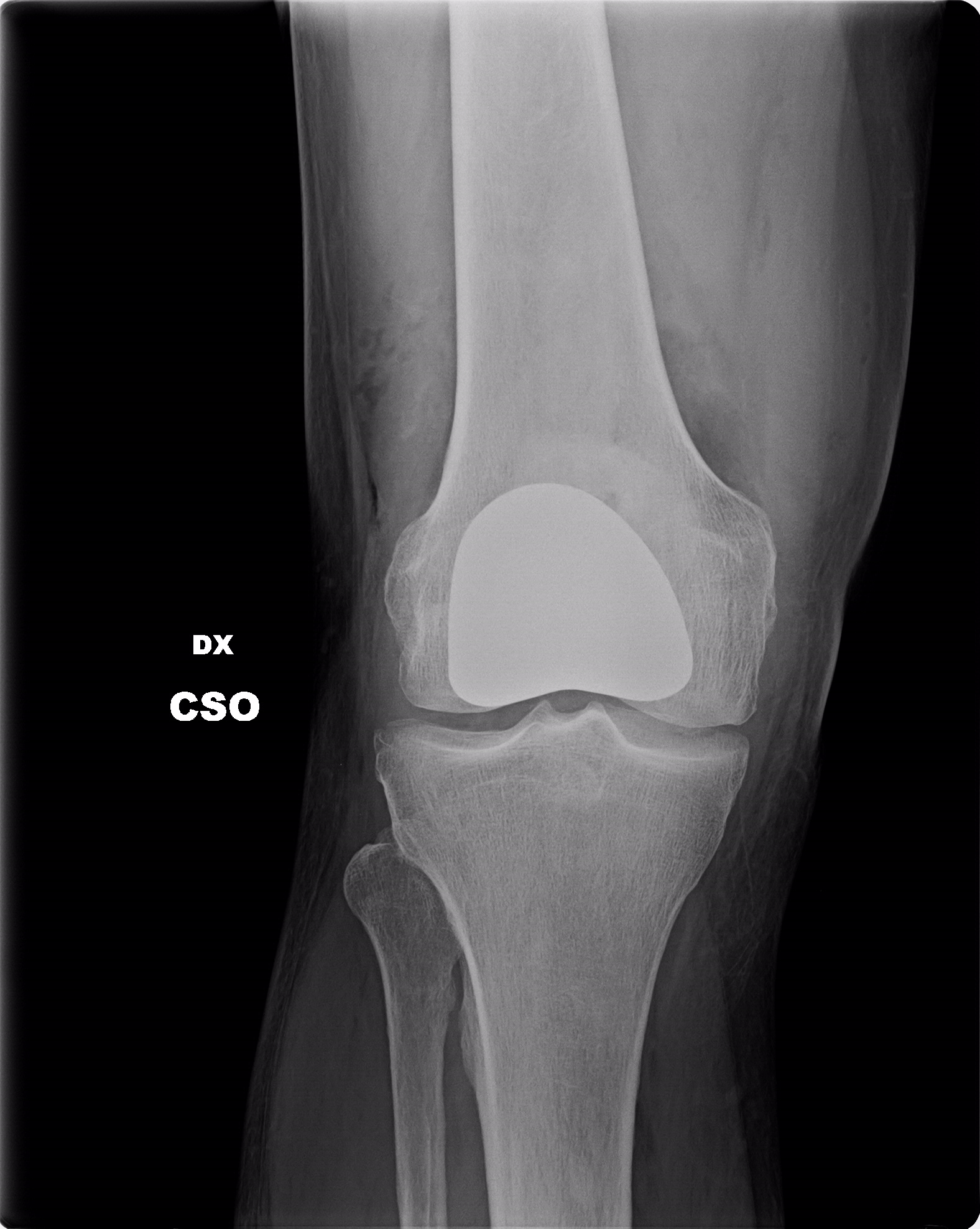 Protesi al ginocchio a Firenze, FI | Dott. Alfredo Lamberti