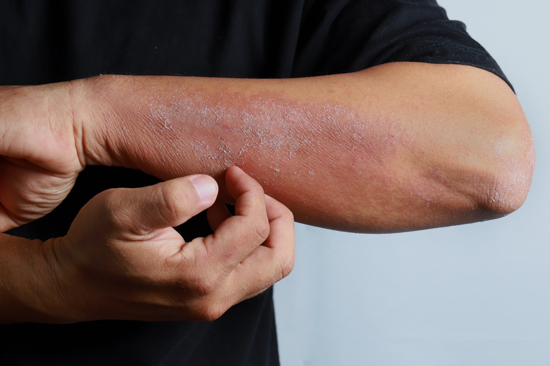 Looking For The Best Eczema Dry Skin Treatment In LA Looking For The Best Eczema Dry Skin Treatment In LA