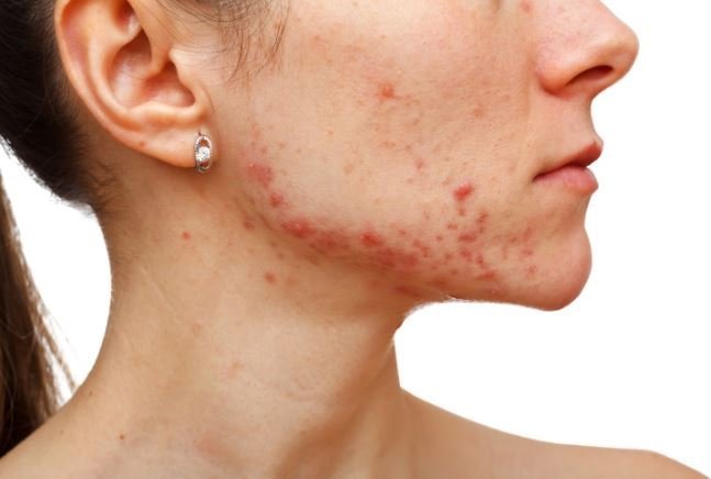 Red Bumps On Face