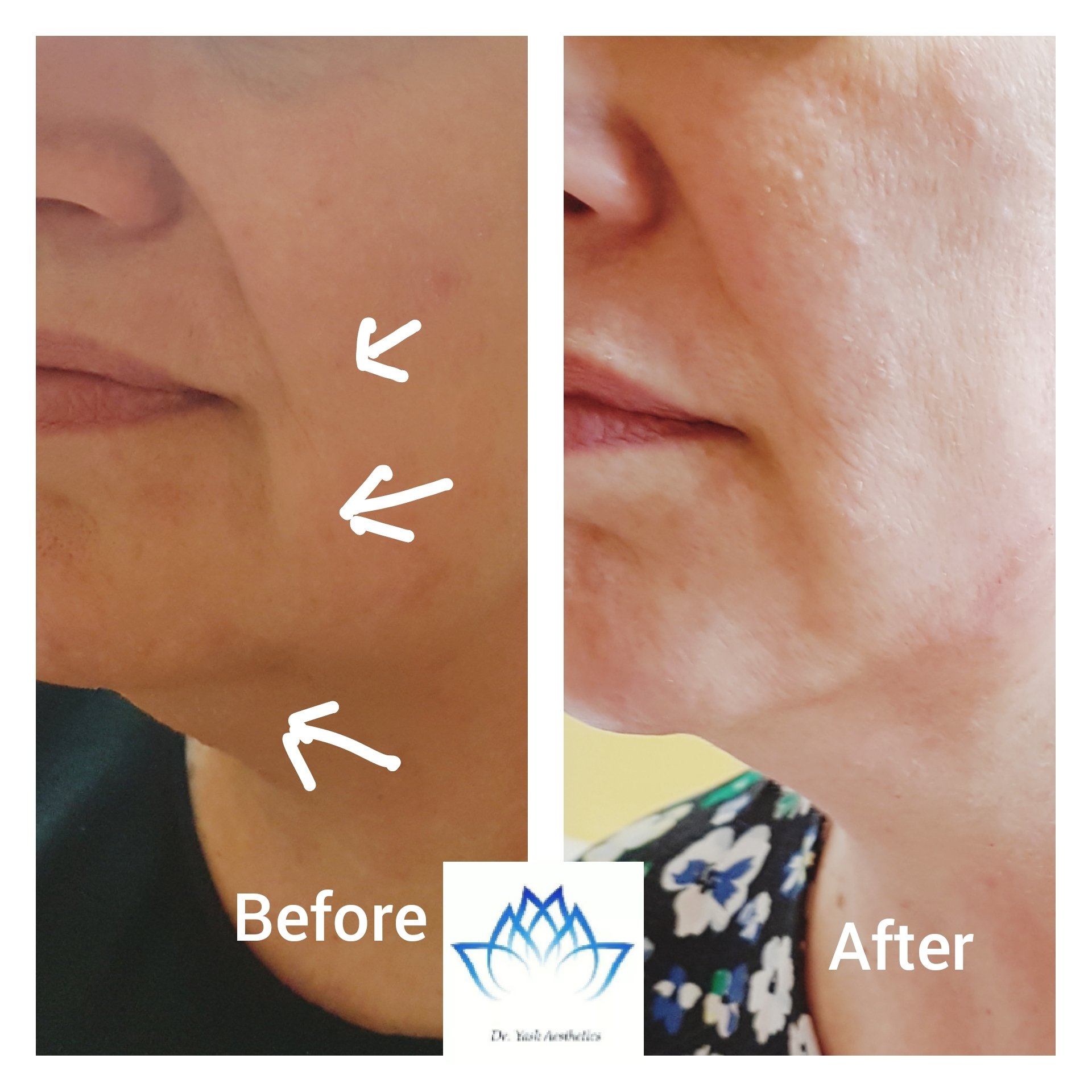 PDO Threading | Dr Yash Aesthetics