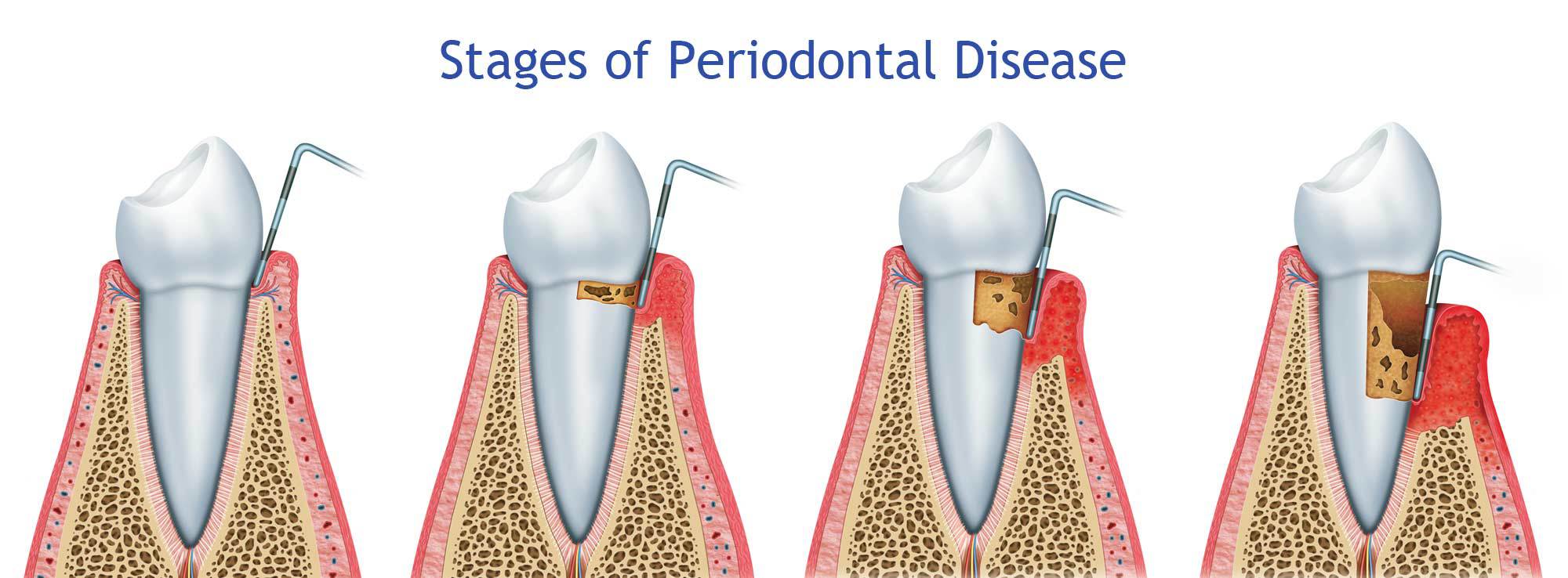 Periodontal Disease Treatment by Periodontist, Dr. Marichia Attalla