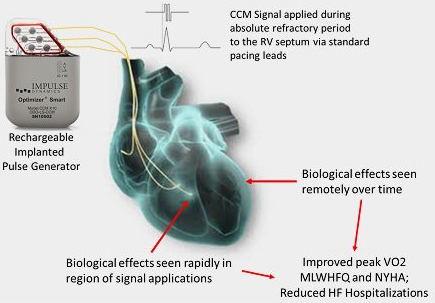 Cardiac Contractility Modulation (CCM) in Daytona Beach, FL