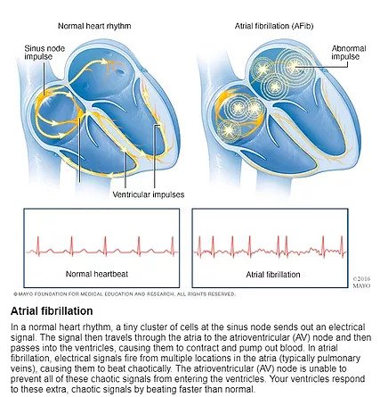 Atrial Fibrillation Treatments in Daytona Beach, FL