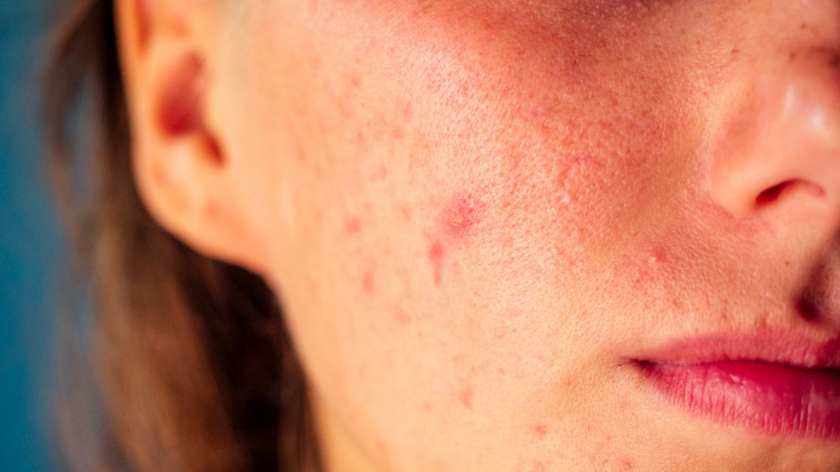 Tudo que você precisa saber sobre acne