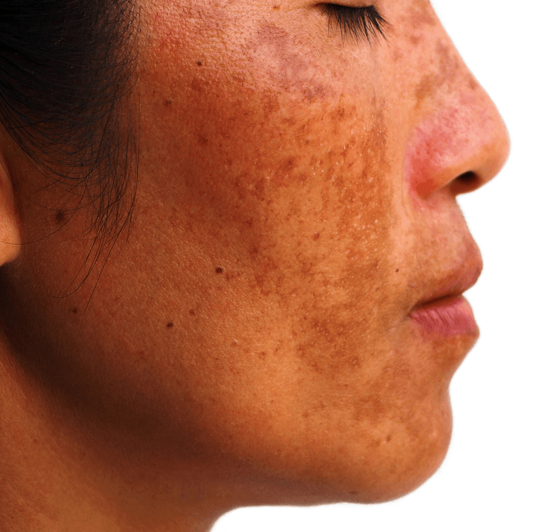 Tratamento de Melasma | Dra. Gláucia Labinas