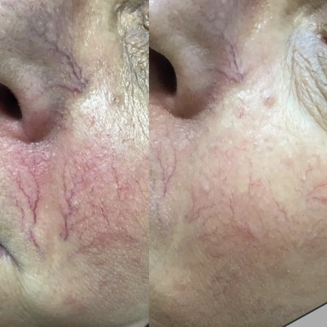 Thread Vein Removal | Specialist Clinic Wetherby | Revekka Treatments