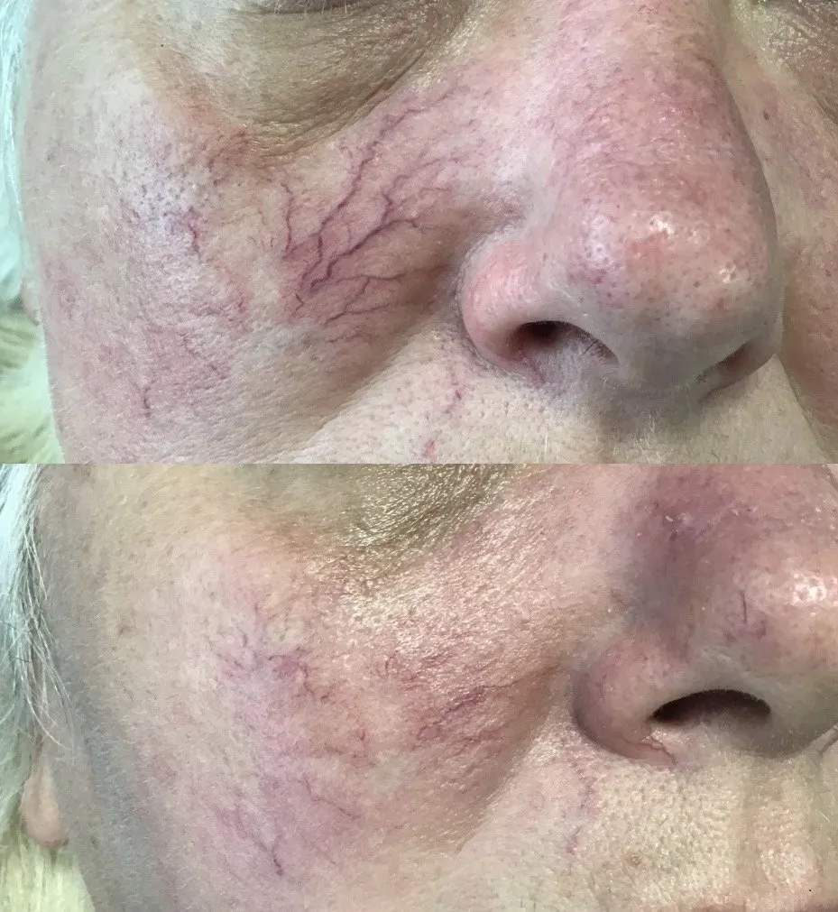 Thread Vein Removal | Specialist Clinic Wetherby | Revekka Treatments