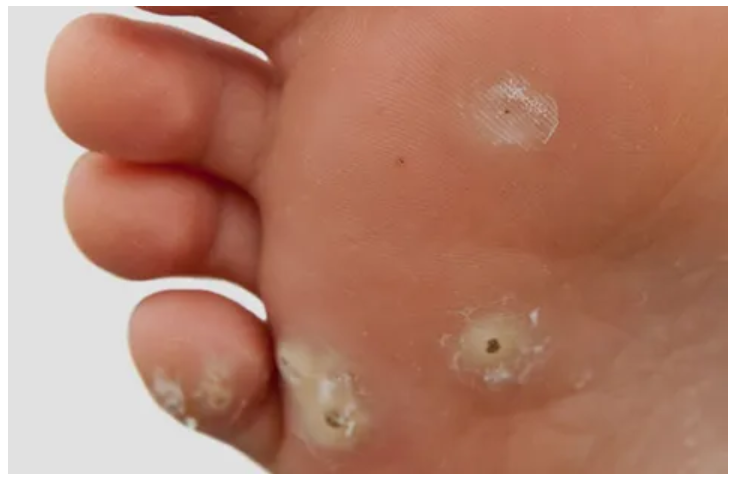 Podiatry Clinic | Foot Clinic Headingley | Revekka Treatments