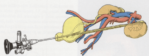 Ureteroscopia rigida e flessibile Genova - Ninotta Urologo