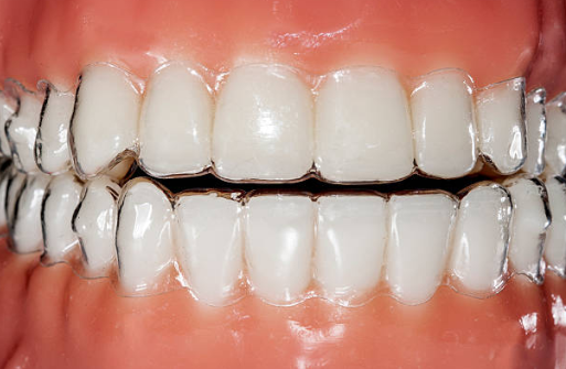 Invisalign | Boston, MA | Boston Orthodontics