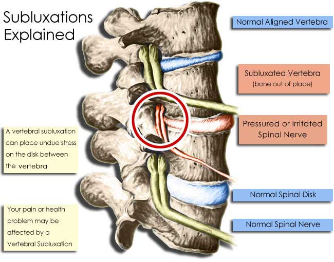 Athens, GA Vertebral Subluxation - Five Points Chiropractor