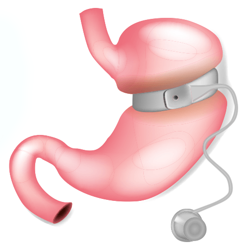 Gastric Band Removal| Dr David Links | Randwick