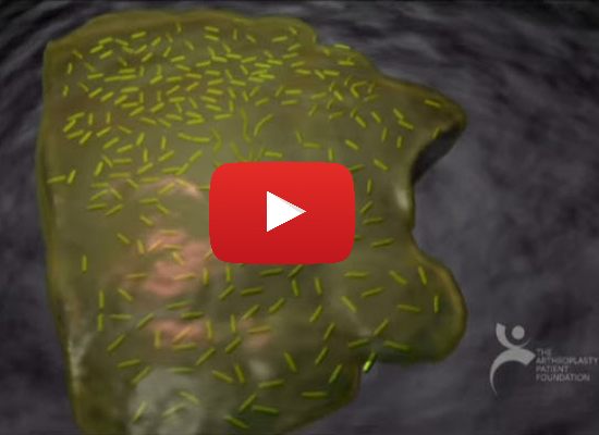 BACTERIA BIOFILM - First step in PERSISTENT MICROBIAL INFECTION