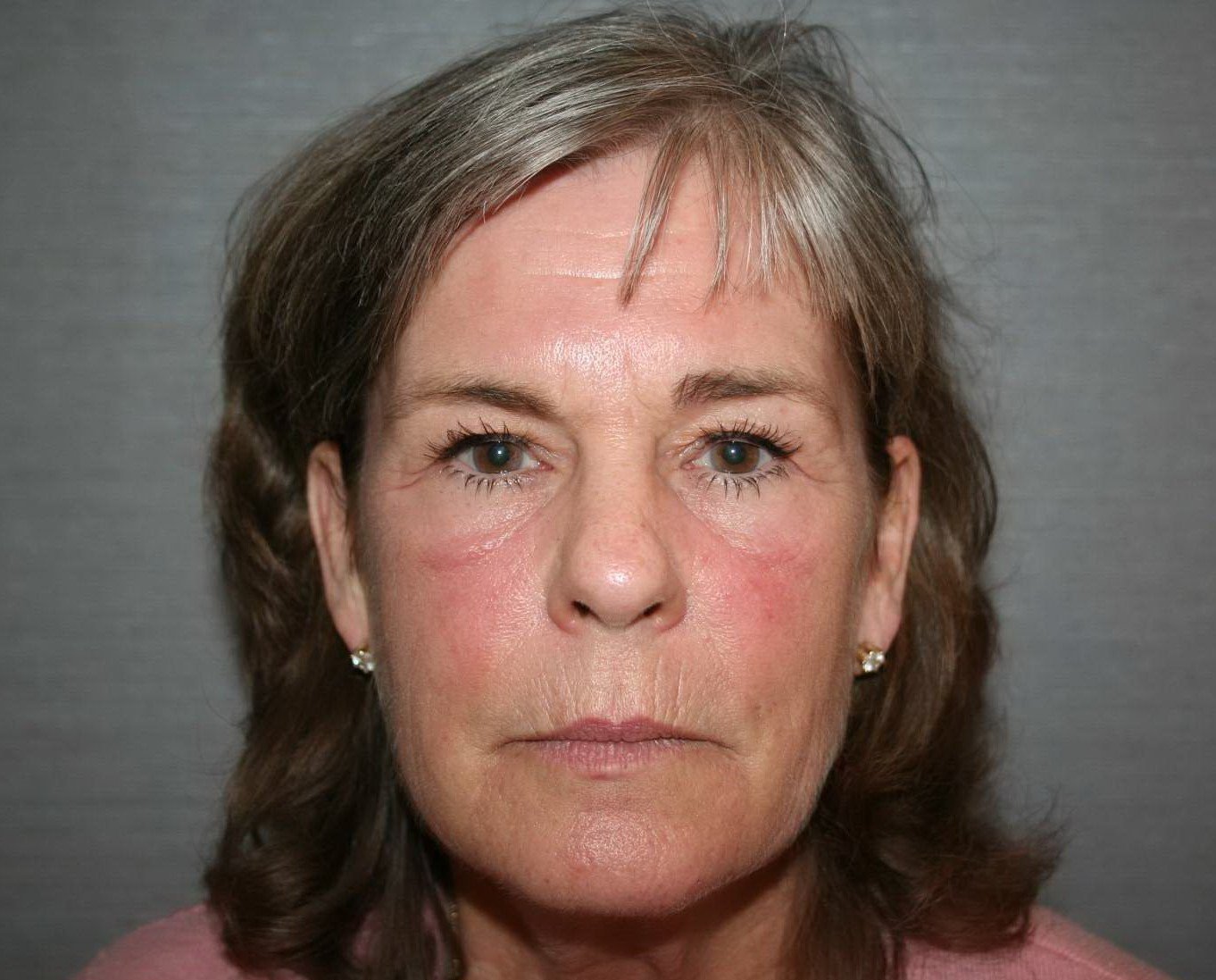 Plastic Surgeon Connecticut | Boris Goldman, MD