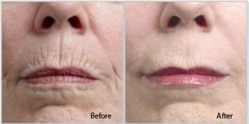 Fractional Co2 Face Laser Treatment In The Boston And Providence Area