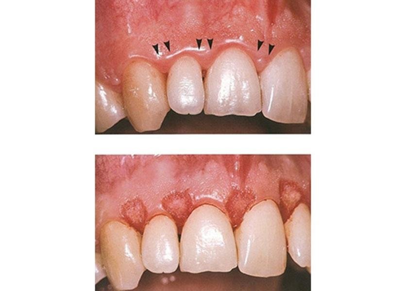 Cura della Parodontite a Roma | Studio Dentistico Ortuso