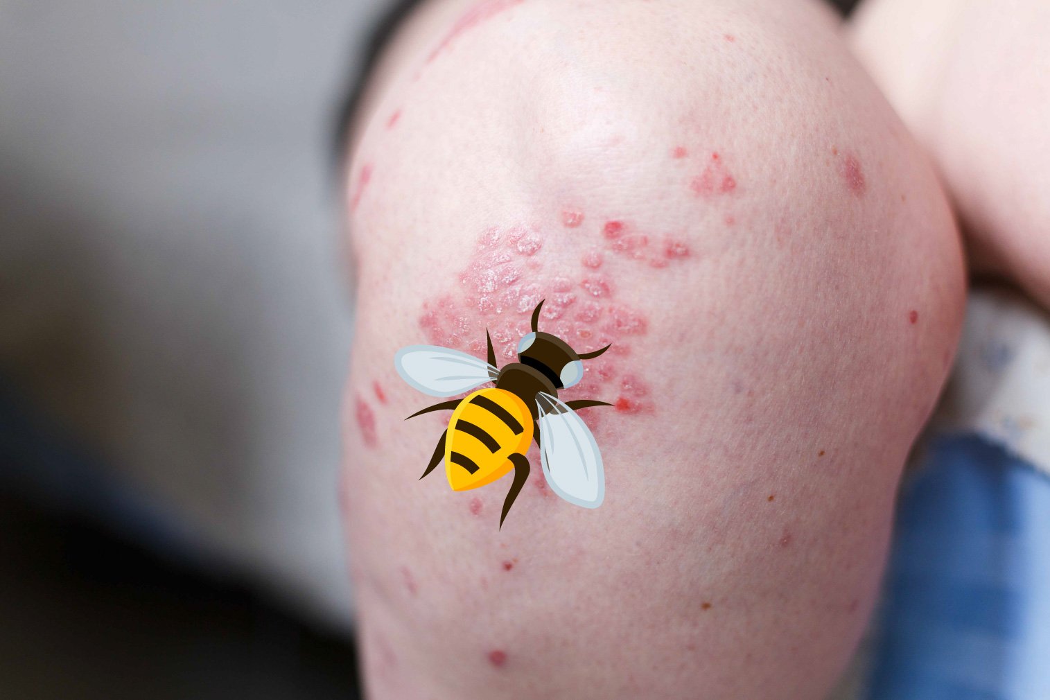 Allergy Treatments | Iowa Allergy