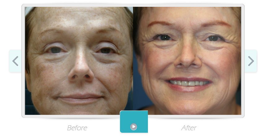 Fractional Laser Resurfacing in Jacksonville, FL | Smooth and Renew ...