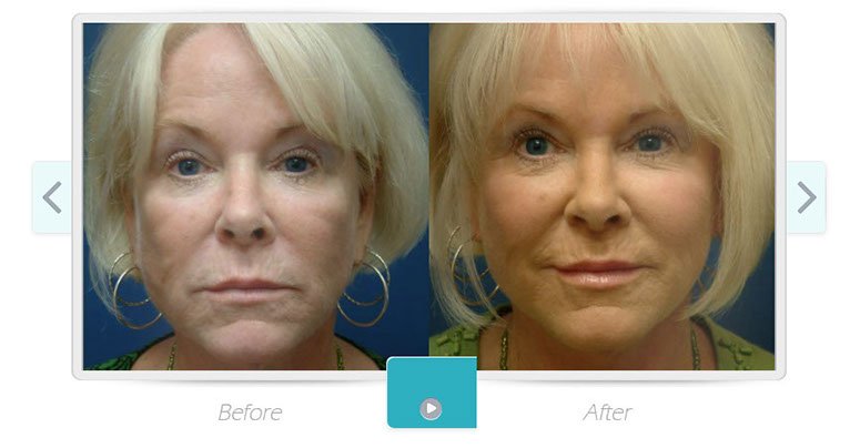 Radiesse Fillers in Jacksonville, FL | Long Lasting Lift and Facial ...