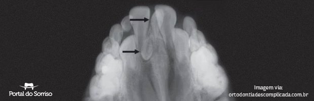 Dentes supranumerários: Quando surge um dente a mais