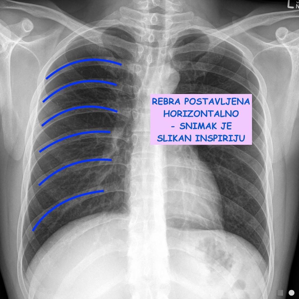 INTERPRETACIJA RTG P/C