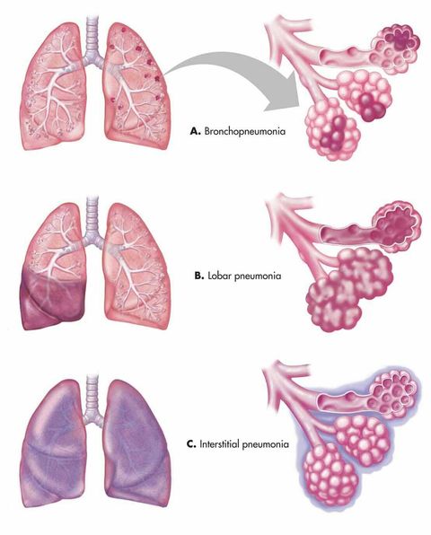 PNEUMONIA