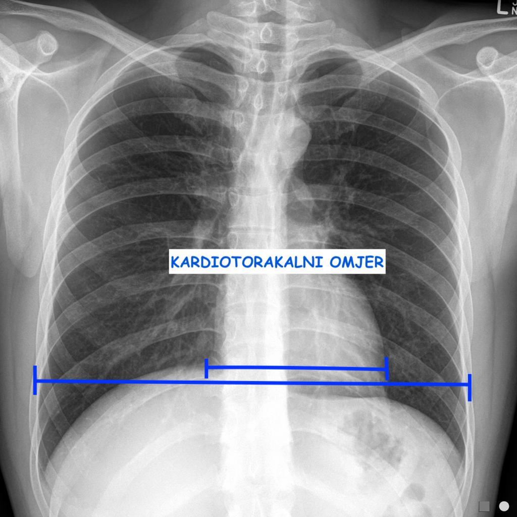 INTERPRETACIJA RTG P/C