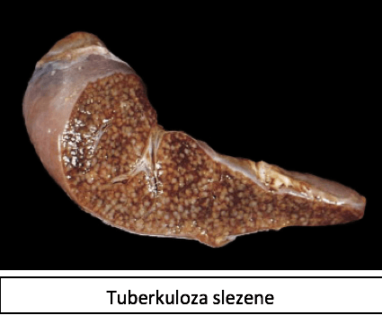 TUBERKULOZA