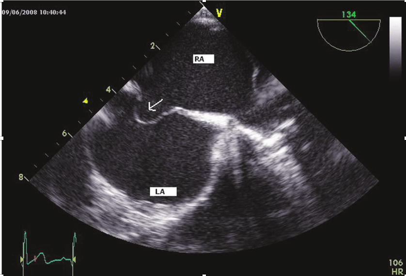 UROĐENE SRČANE MANE ODRASLIH (USM)