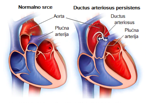 UROĐENE SRČANE MANE ODRASLIH (USM)- 2.dio