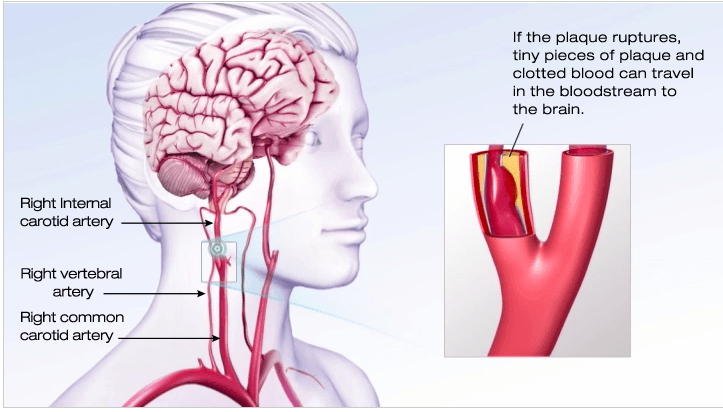 CERVEBROVASKULARNI INZULT (CVI)