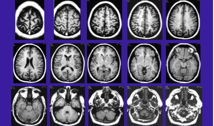 OSNOVE MRI - NAČIN NASTANKA SLIKE NA MRI