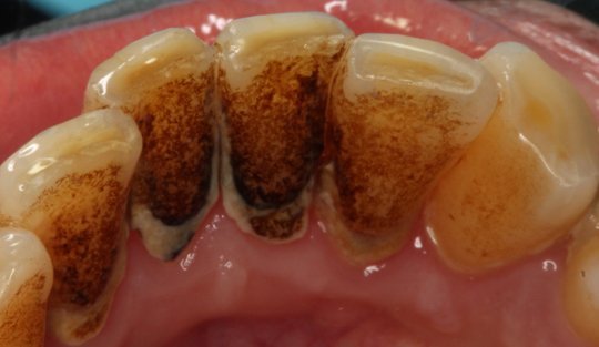 Scaling and air polishing from the experts in Cardiff