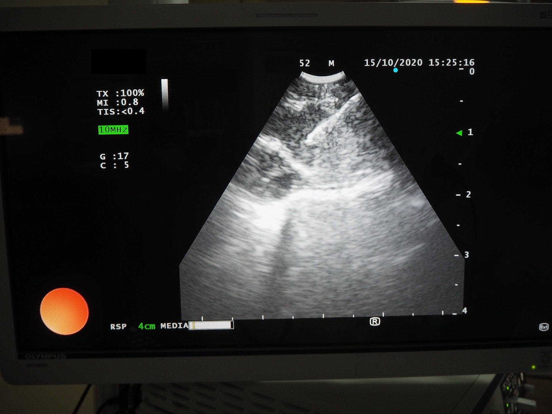 Ebus-TBNA | Respiratory Medical Associates
