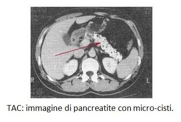 Disturbi del pancreas - Roma - Dott. Prof. Iannetti - Pancreatite acuta ...