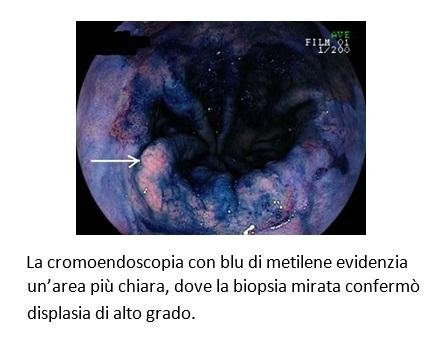 Malattia di Barrett - Roma - Dott. Prof. Antonio Iannetti - Esofago di ...