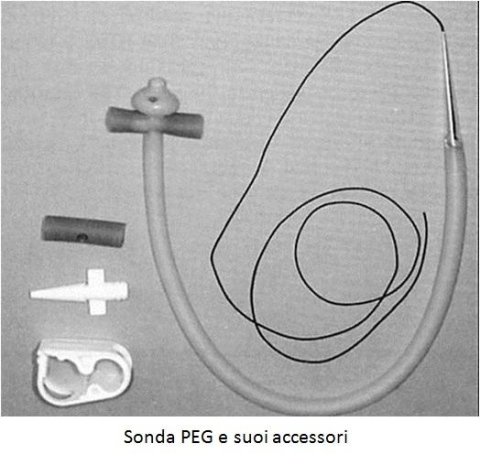 Gastrostomia percutanea - Roma - Dott. Prof. Antonio Iannetti - PEG o ...