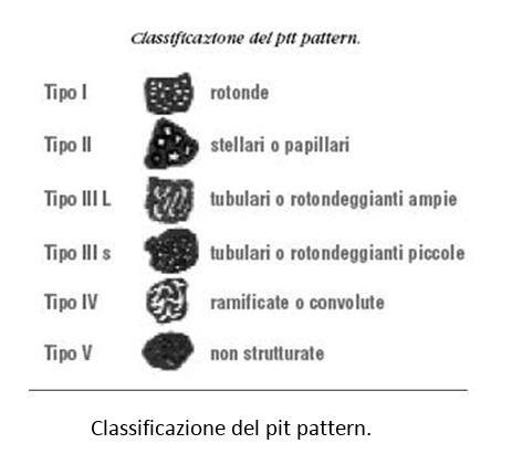 Classificazione polipi - Roma - Dott. Prof. Antonio Iannetti - Polipi ...