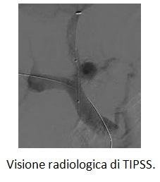 Dilatazione delle vene - Roma - Dott. Prof. Antonio Iannetti - Varici ...