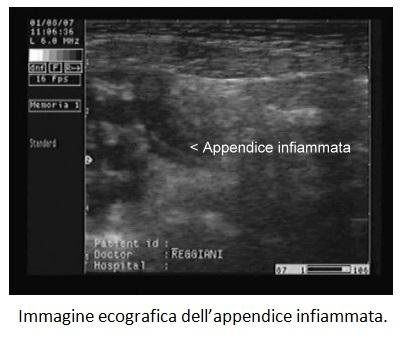 Infiammazione dell'appendice - Roma - Prof. Dott. Antonio Iannetti ...
