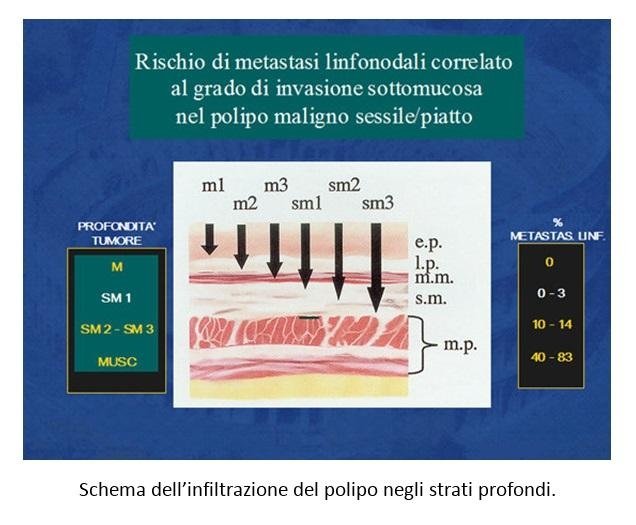 Classificazione polipi - Roma - Dott. Prof. Antonio Iannetti - Polipi ...