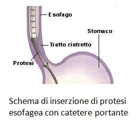 Endoprotesi - Roma - Dott. Prof. Iannetti - Protesi Endoscopiche